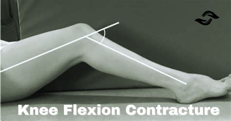 Knee Flexion Contracture Causes And Exercises Physio Health And