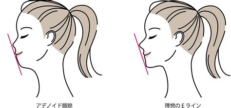 アデノイド顔貌を大人になってから治すには？3つの改善法と3つの治療法を紹介 Sillha【シルハ】 お口を10秒すすぐだけ。口内環境が