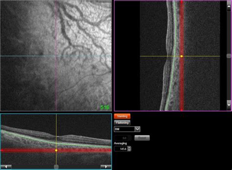 Choroidal Vascular Anomalies Posterior Vortex Veins Choroidal Macrovessels Choroidal