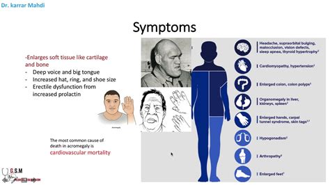 6 Acromegaly Youtube