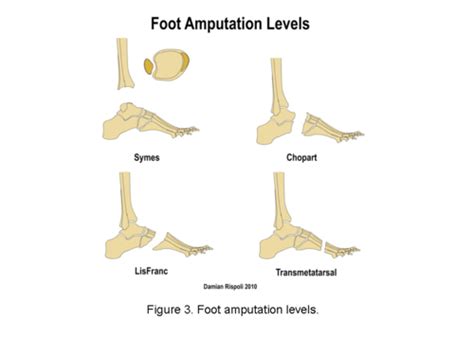 Prosthetics Flashcards Quizlet