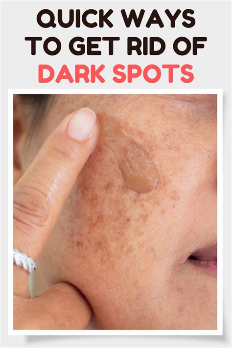 QUICK WAYS TO GET RID OF DARK SPOTS Dark Spots Brown Spots Removal Age Spots On Face
