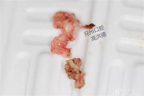 牙龈切除前后对比 牙龈切除术 牙齿长到牙龈上龈图片 第15页 大山谷图库