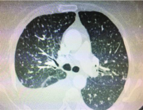 Axial Computed Tomography Showing Diffuse Miliary Nodules And Right Download Scientific Diagram