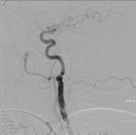 Acute Ischemic Stroke In The Third Trimester Of Pregnancy