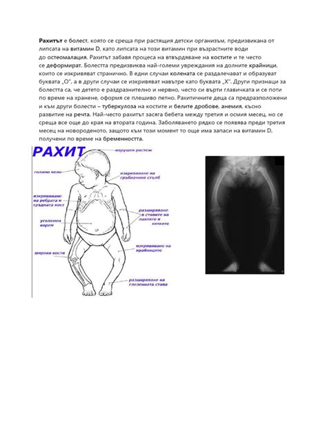 Кифоза и рахит Pdf