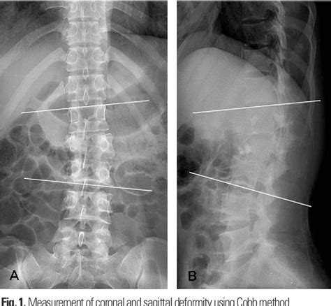 Table 1 From Measurement Of Canal Encroachment Using Axial And Sagittal