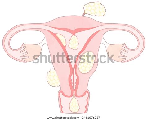 Blank Types Uterine Fibroids Unlabeled Diagram Stock Illustration