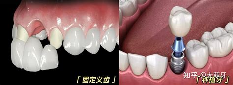 牙医经验之谈——牙齿缺失怎么办？种牙好还是镶牙好？ 知乎