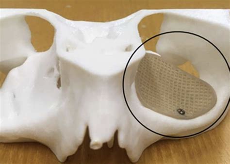 Unique Porous 3d Printed Implants Designed To Treat Eye Socket