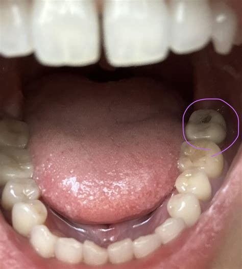 What Is This Gray Small Circle On Top Of My Bottom Left Crown Wont