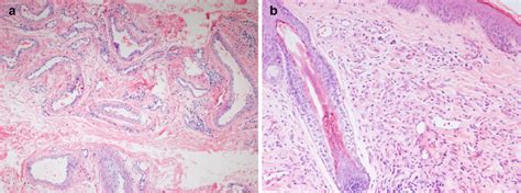 Histology Of Vascular Malformations Oncohema Key