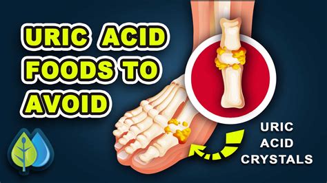 Top 10 Uric Acid Foods To Avoid If You Have Gout