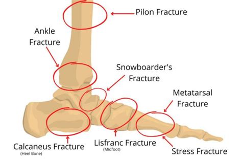 Break Ing Down Foot And Ankle Fractures Foot And Ankle Wellness Center