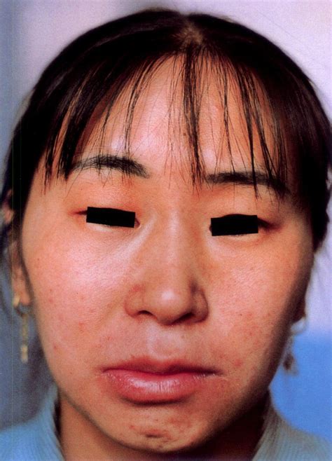 Melkersson Rosenthal综合征 临床皮肤病学图谱