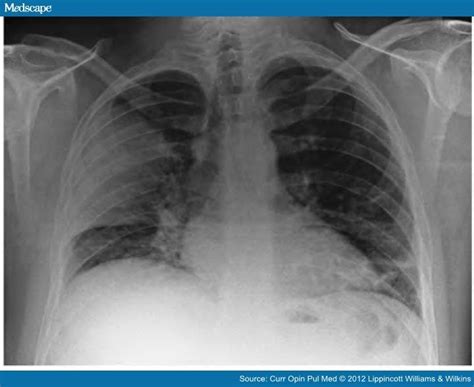 Reviews On How To Cure Candida Treatment Of Candida Albicans Pneumonia Bladder Infection And
