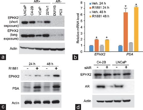 Clinical Significance Of Ephx2 Deregulation In Prostate Cancer Pmc