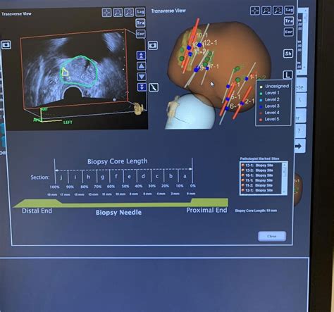 Semi Robotic System Of Mri Ultrasound Fusion Prostate Biopsy Agwaad