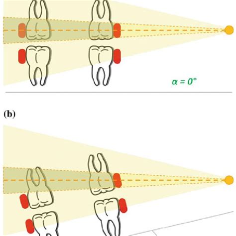 Frontal Scheme View Of The Occlusion Level A Horizontal Position Of Download Scientific