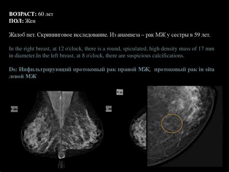 Маммография Заболевания молочной железы презентация онлайн