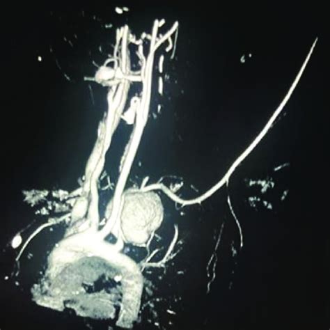 Computed Tomography Angiogram Of The Thoracic Aorta Showing Large Download Scientific Diagram
