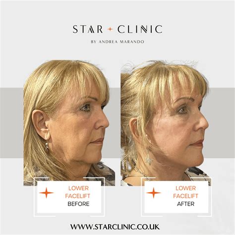 Facelift Vs Botox Which Is Best For You Advanced Plastic Surgery