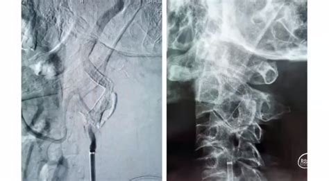 张颖影教授：颈动脉支架术基础培训 脑医汇