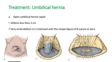 Ventral Hernia Pptx