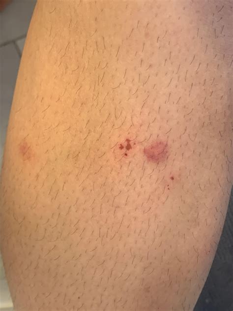 Got Bug Bites After Being At The Park R Bugbites