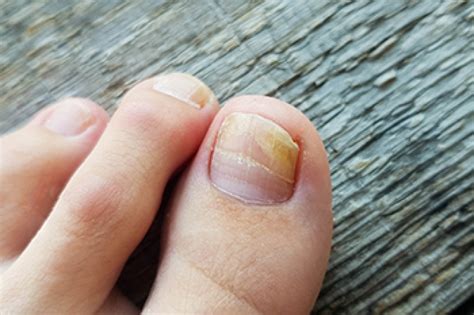 Different Types Of Toenail Fungus