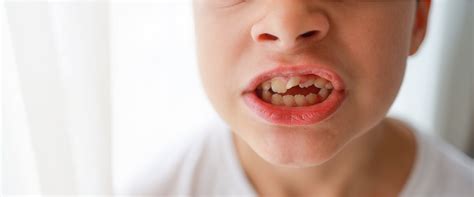 Open Bite Everything You Need To Know About This Common Jaw Misalignment CURAPROX