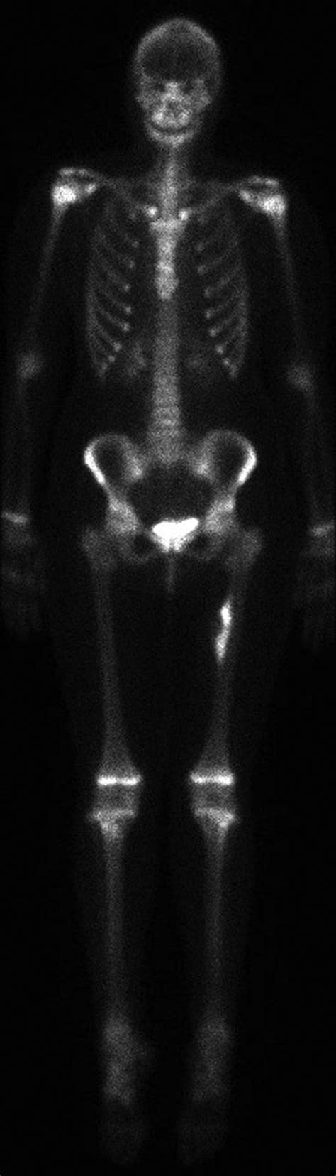 Imaging Of Bone Sarcomas Clinical Tree