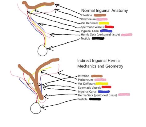 Indirect Vs Direct Hernia Anatomy