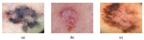 Skin Cancer And Its Types At Tyson Walsh Blog Skin Cancer And Its Types At Tyson Walsh Blog