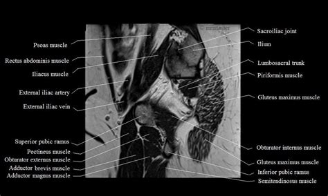 Mri Female Pelvis Anatomy Free Mri Sagittal Cross Sectional Anatomy