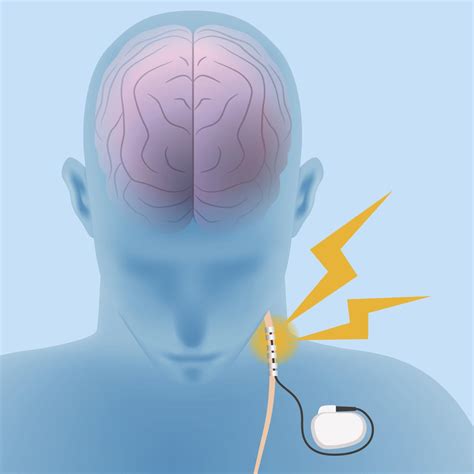 stimulating peripheral activity to relieve conditions sparc phase 2