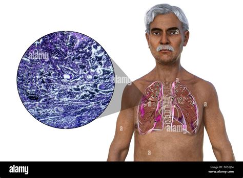 Illustration Of A Man With Lungs Affected By Silicosis Showing Dark Silicotic Nodules And A