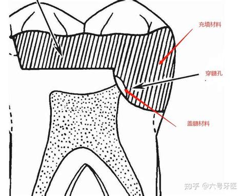 牙科临床处理牙髓药物——活髓保存药物。 知乎