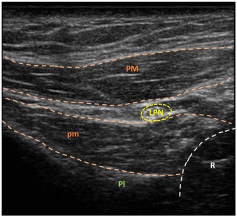Ilioinguinal Nerve Block Ultrasound Ilioinguinal Nerve Block Ultrasound