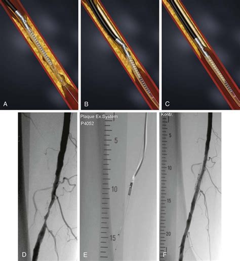Atherectomy Devices Radiology Key