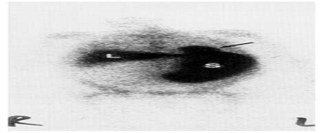 Infection Of A Left Ventricular Aneurysm And Massive Splenom