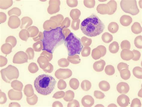 Myelodysplastic Syndromes Mds Flow Cytometry