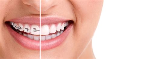 Invisalign Dentist In Cary Nc Top 3 Benefits To Invisalign