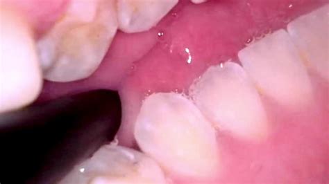 Can You Check My Braces Xxx Mobile Porno Videos Movies IPornTV Net