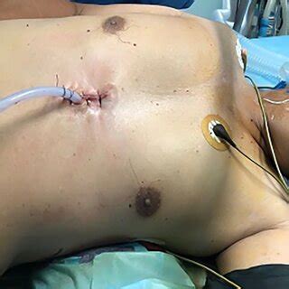 Subxiphoid Incision Extending From The Xiphisternal Junction To Cm Download Scientific