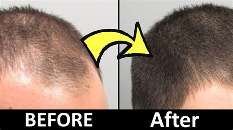 How To Regrow Receding Hairline Naturally Tips And Tricks Best Simple