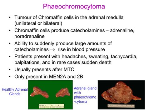 Ppt Multiple Endocrine Neoplasia Type 2 Powerpoint Presentation Free