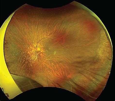Right A And Left B Wide Field Fundus Photographs Note A