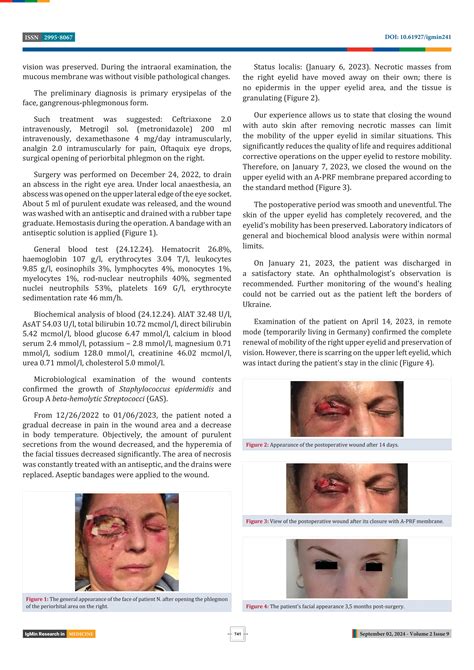 Necrotizing Facial Erysipelas A Rare Upper Eyelid Complication Pdf