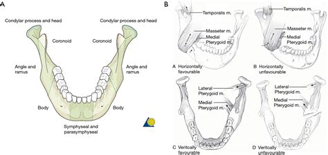Panorex Mandible Fracture